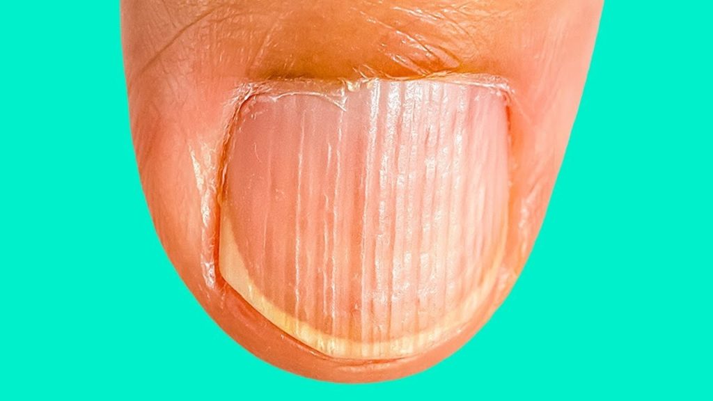 What Those Vertical Lines on Your Nails Could Really Mean – Doctors Say ...